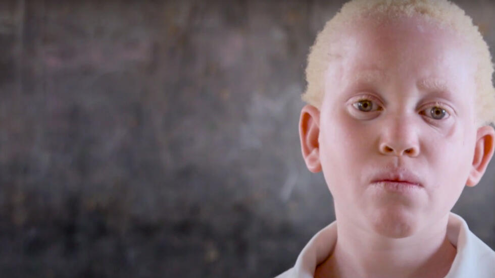 Edward Snowden a écrit une lettre de soutien à une albinos du Malawi