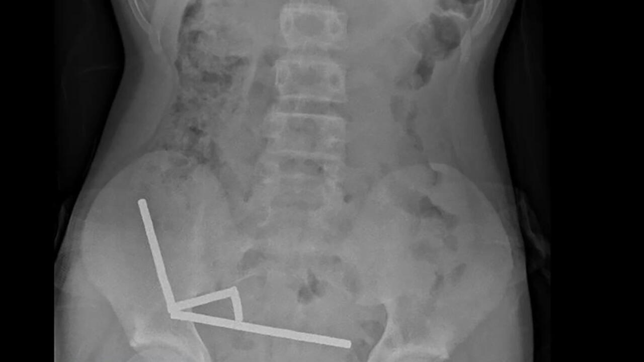 Surgeons remove up to 100 magnets from N. Zealand teen's gut