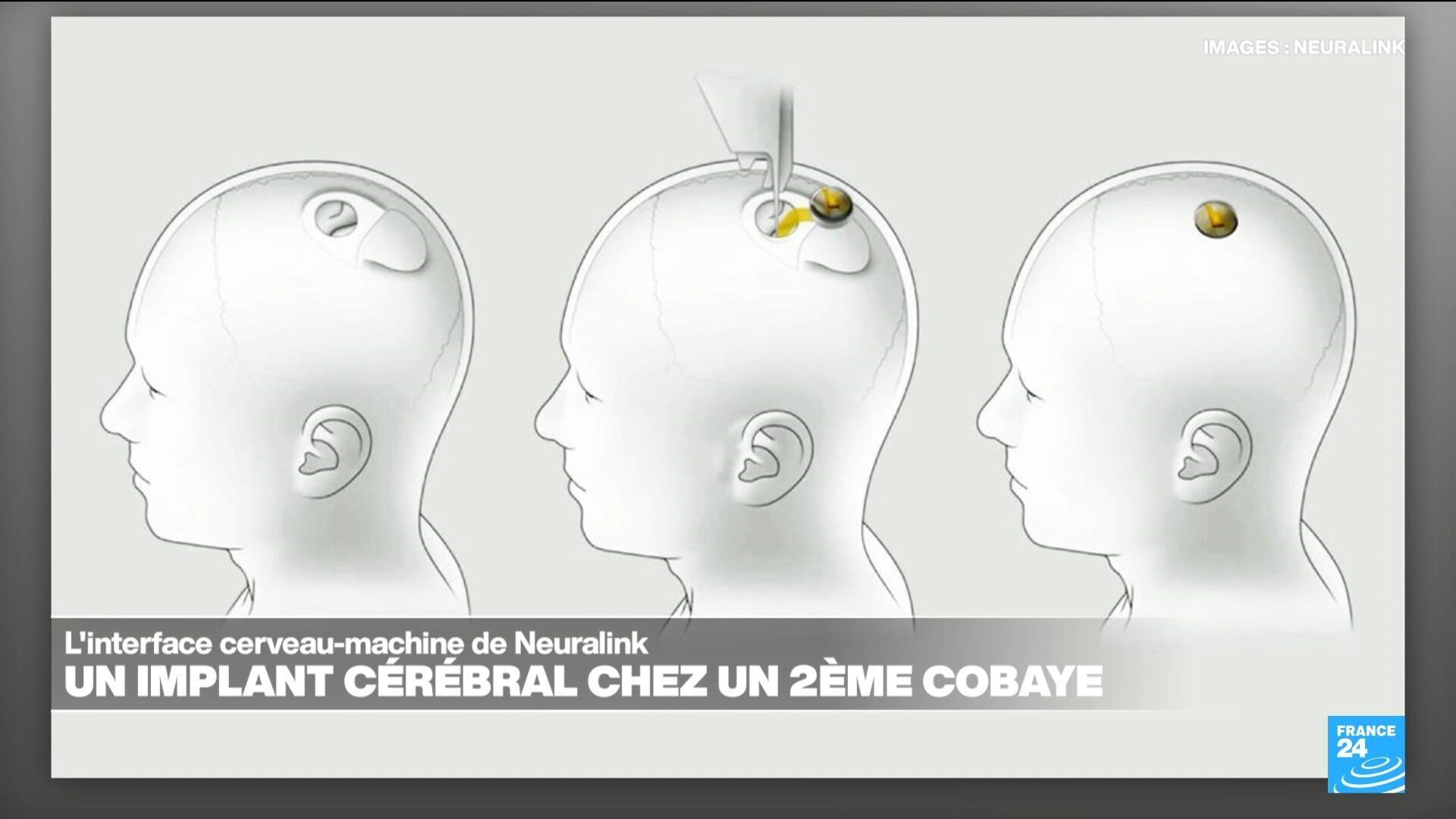 Neuralink : un implant cérébral bientôt chez un second cobaye - Sciences
