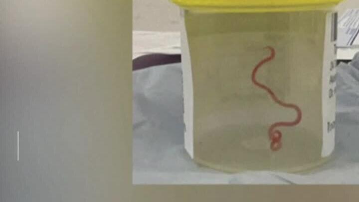 Worm found in woman's brain: 8cm creature was living in Australian ...