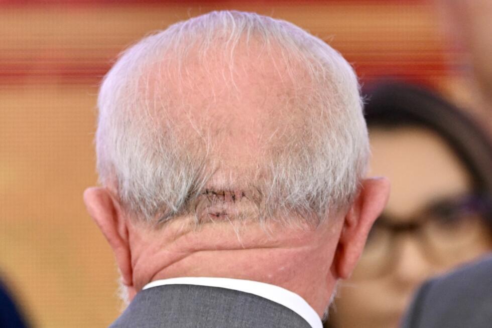 Brazilian President Lula's long history of health woes