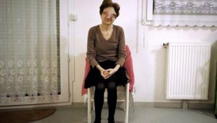 Case of Chantal Sebire pushes euthanasia debate