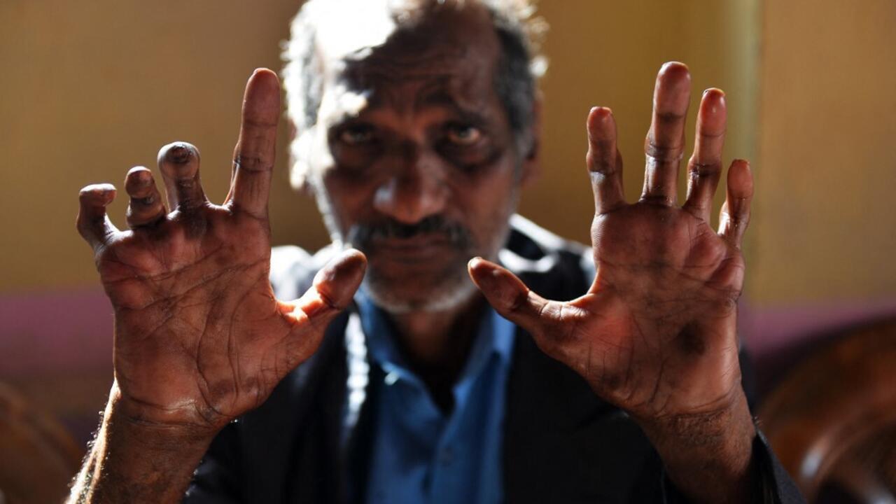 La lepra podría ser endémica en zonas de Florida, según autoridades ...